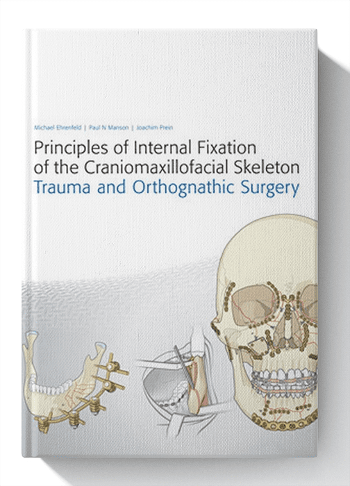 Principles of Internal Fixation of the Craniomaxillofacial Skeleton ...