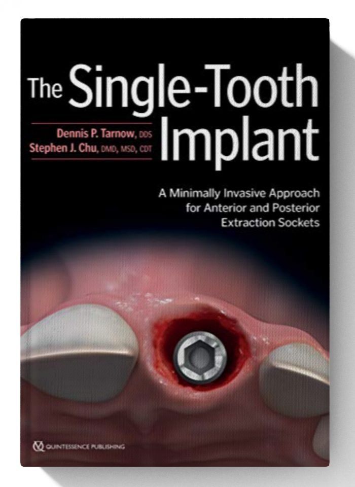 The Single-Tooth Implant: A Minimally Invasive Approach for Anterior ...